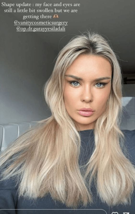 EOTB-Megan onthult resultaat nieuwe cosmetische ingreep